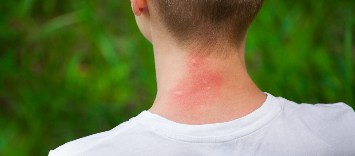 Guía para identificar las picaduras de insectos - Ferri